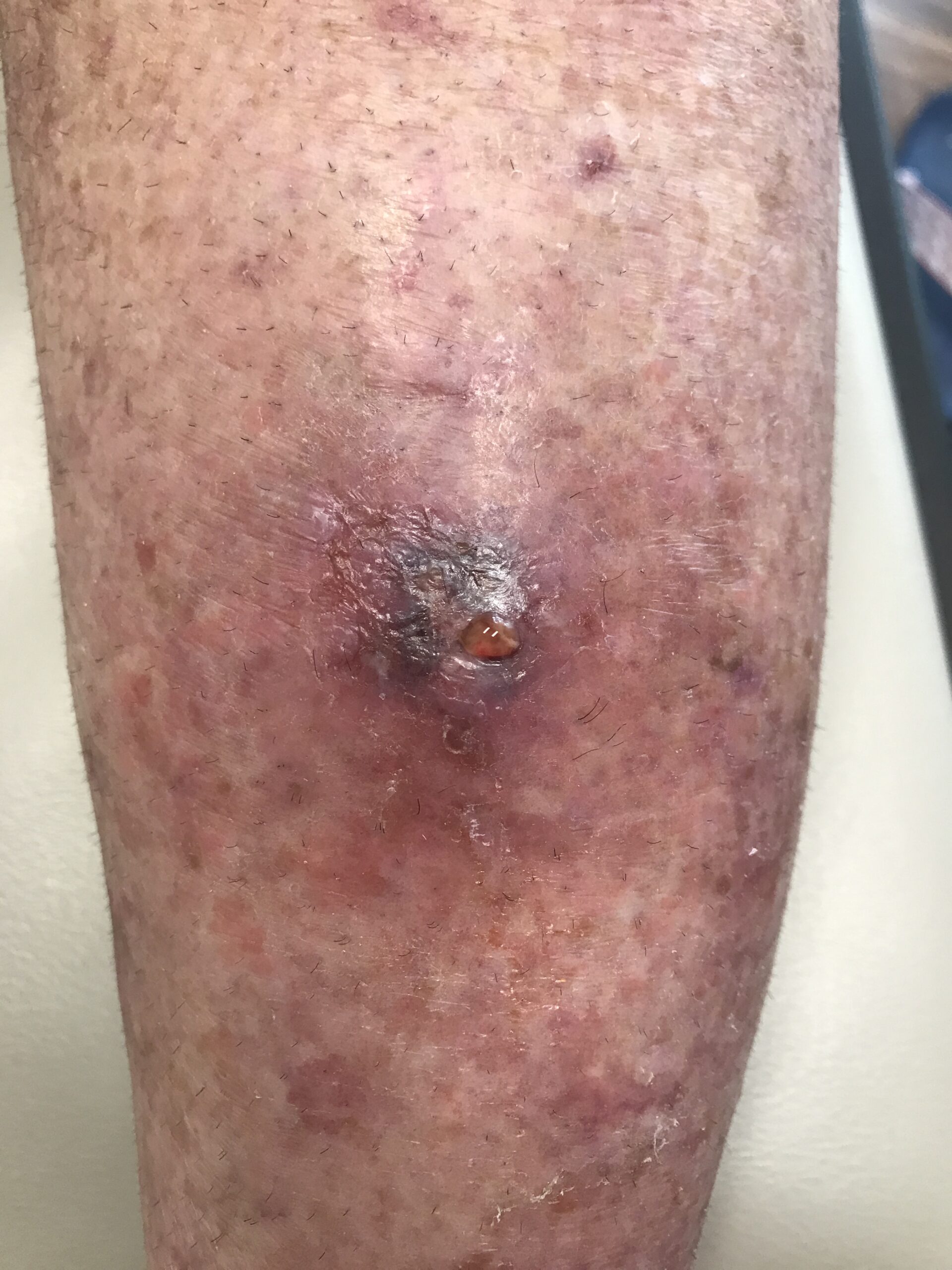 Skin rash: Differential Diagnoses of skin rash on shins