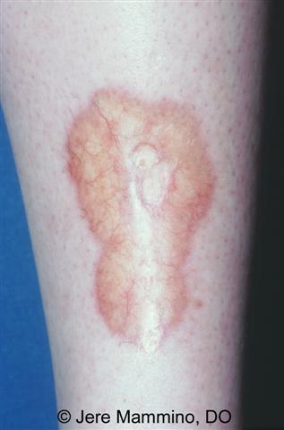 Skin rash: Differential Diagnoses of skin rash on shins