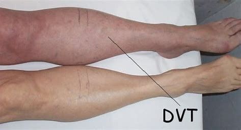 Deep Vein Thrombosis (DVT): Diagnosis & Treatment made simple ...