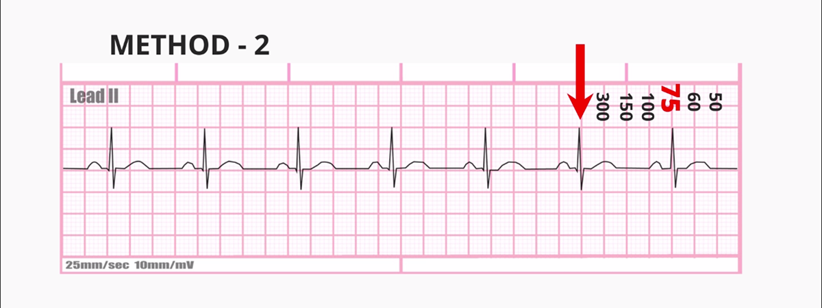 3 Simple Methods of Calculating Heart Rate in ECGs