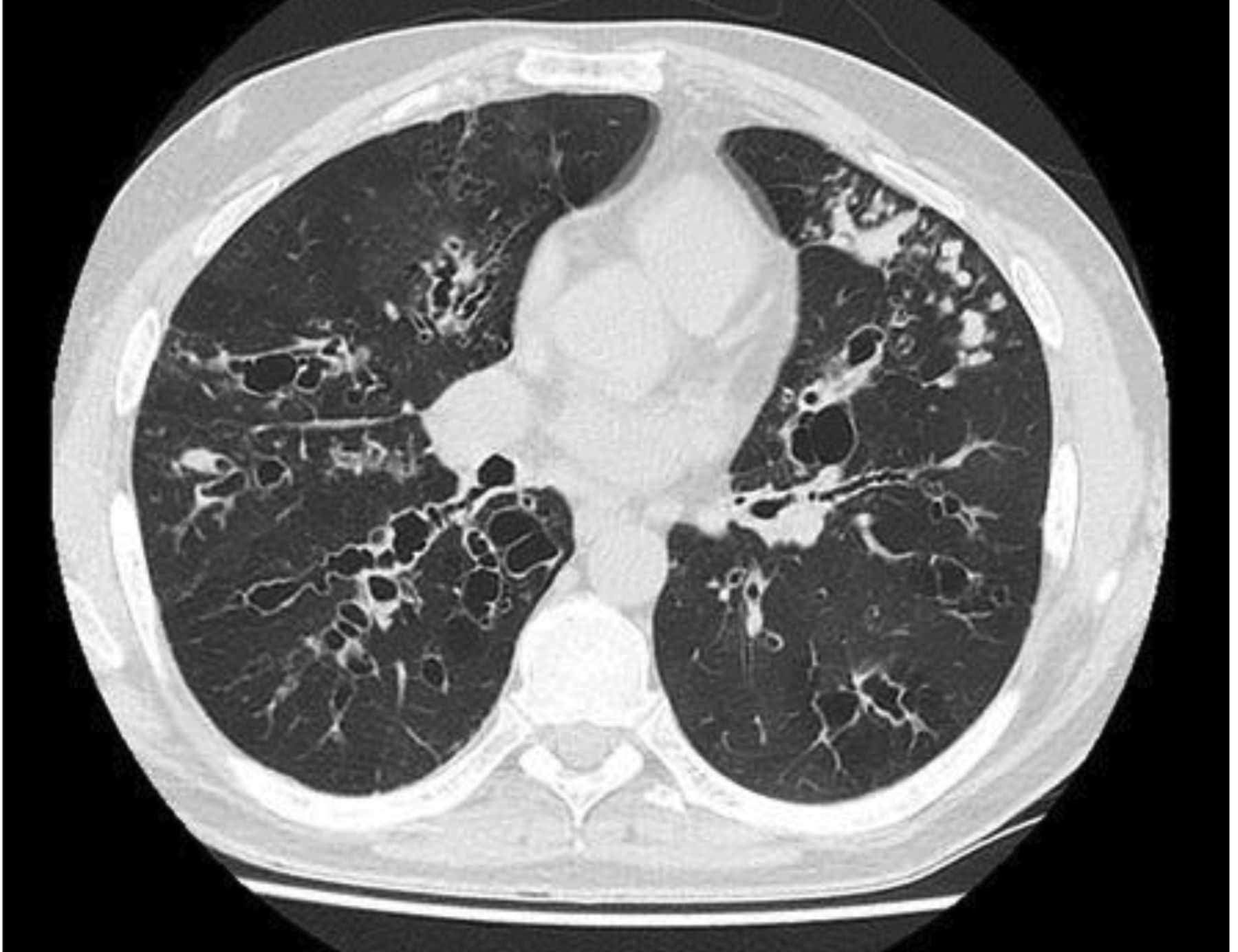 Bronchiectasis: Practical Pearls for YOU!