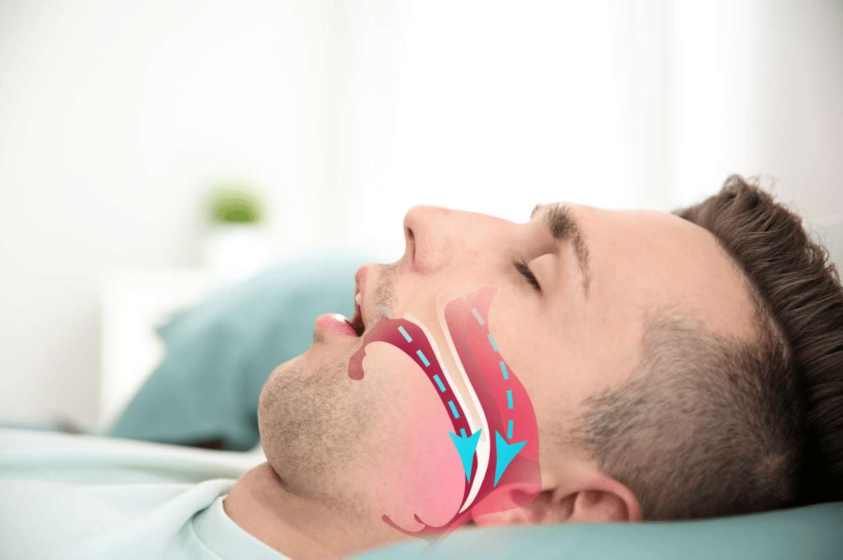 Obstructive Sleep Apnea Hypopnea Syndrome – An Easy Overview!